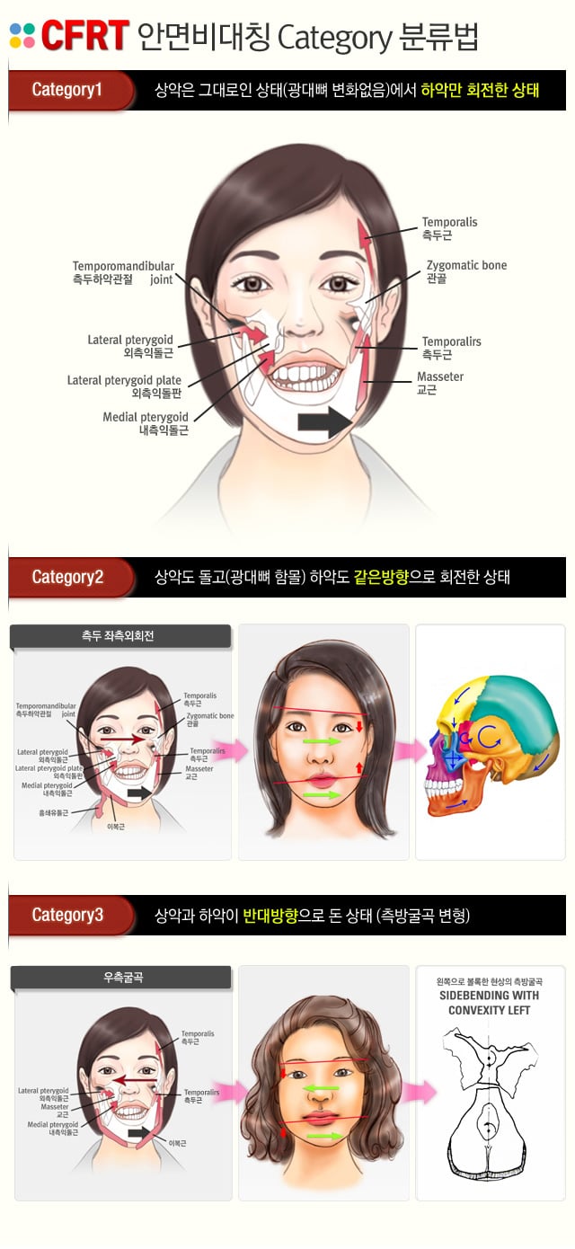 포바즈 두개안면교정 (CFRT : Cranio Facial Reconstructuring Therapy) 소개 : 포바즈 치료법 ...